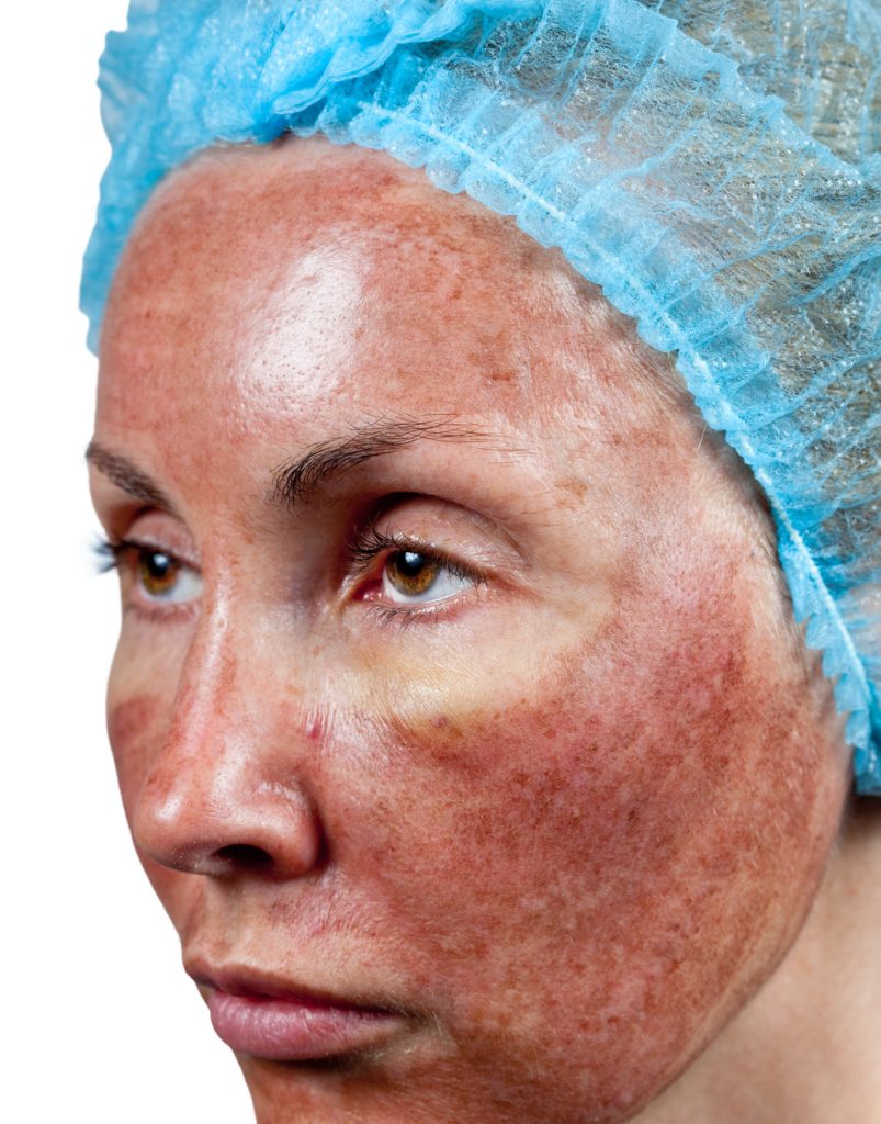 Ácidos para Peeling Químico - Efectos y Resultados - Peeling Químico
