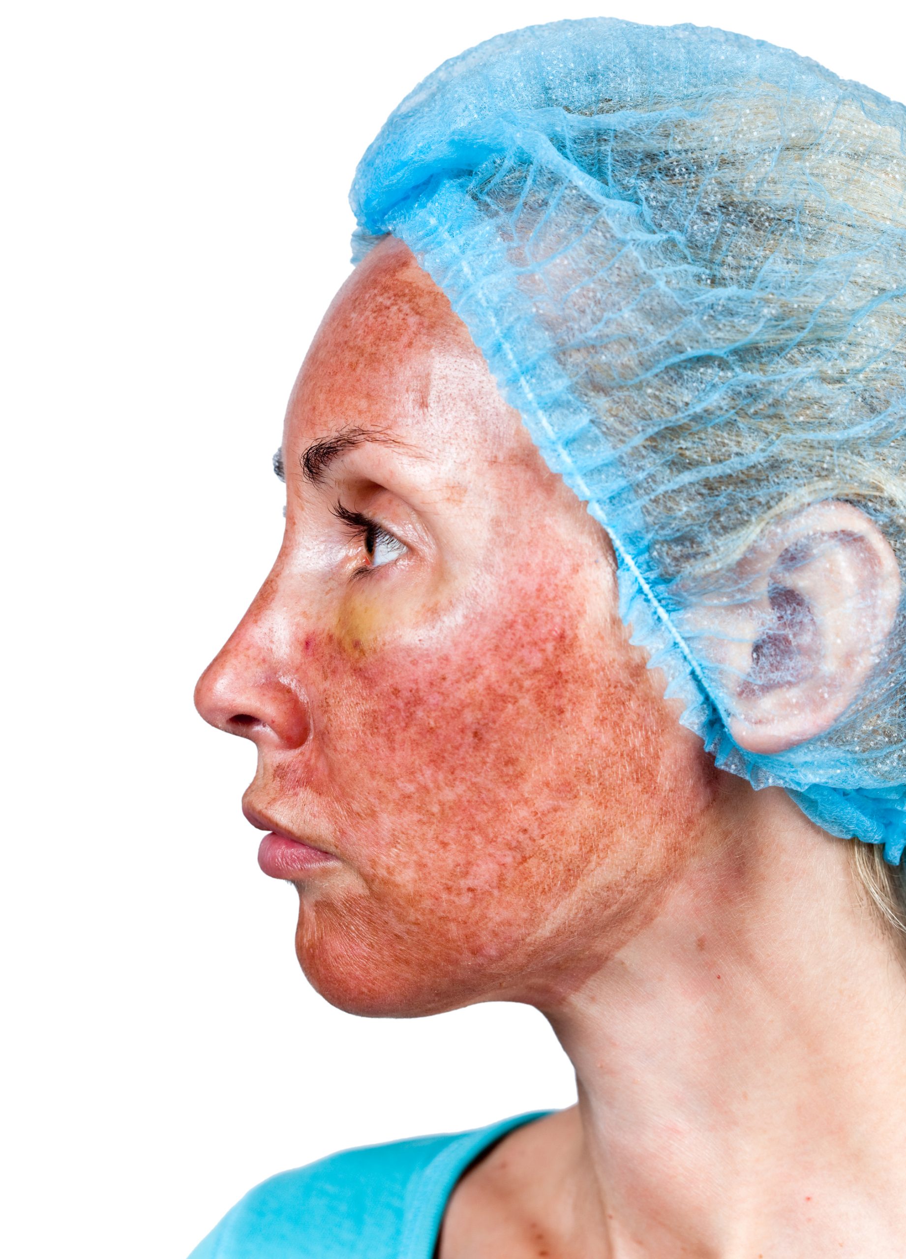 Ácidos para Peeling Químico - Efectos y Resultados - Peeling Químico